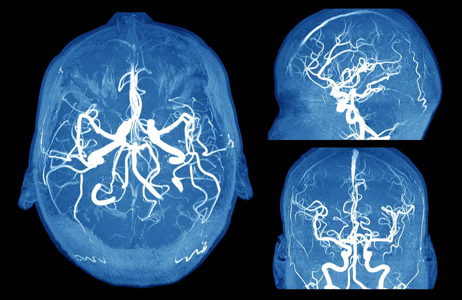 Brain Aneurysm Miami Vascular Specialists Brain Aneurysm Miami Vascular Specialists